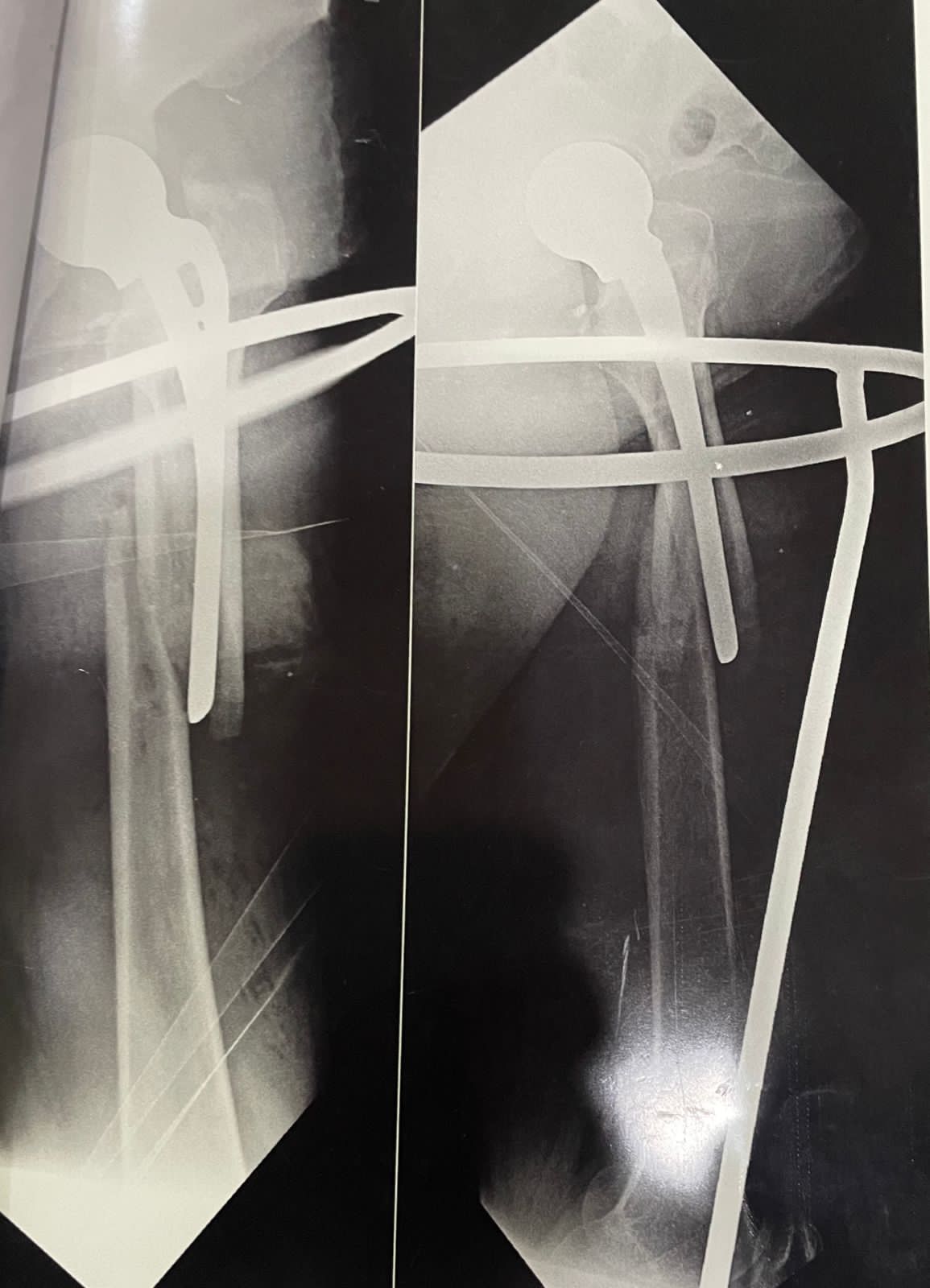 Successful Revision Surgery for Complicated Femur Fracture: A Case ...