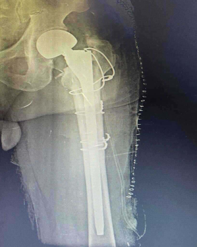 Successful Revision Surgery for Complicated Femur Fracture: A Case ...